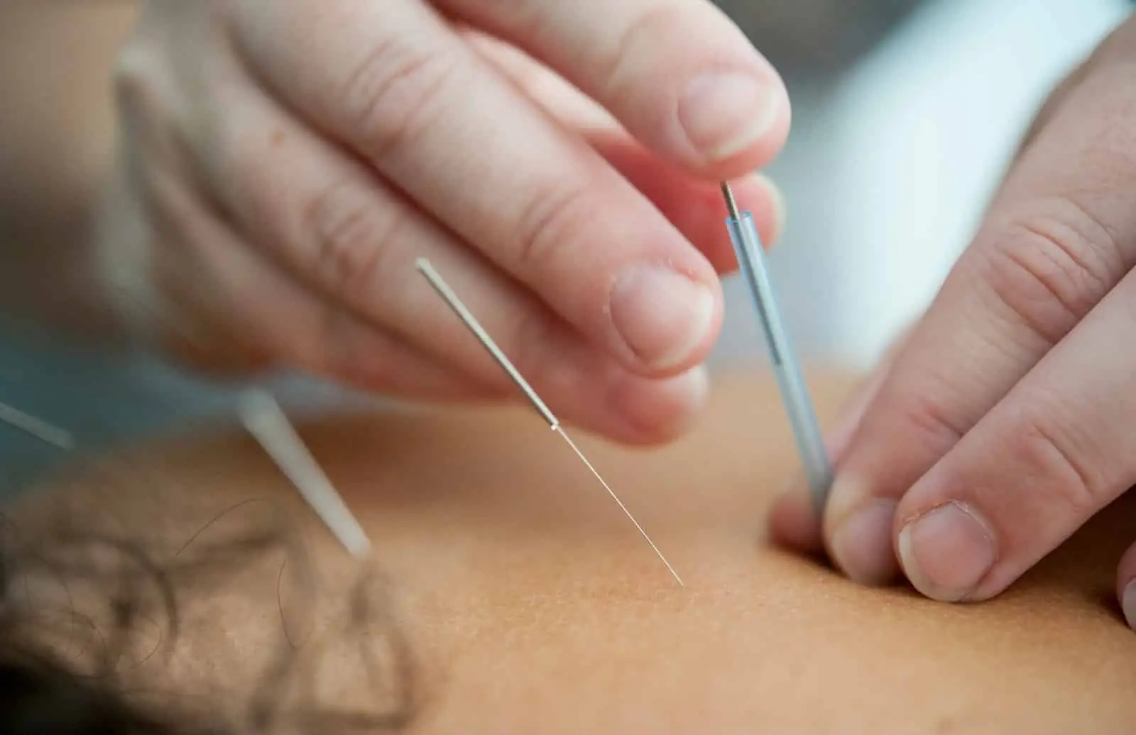 Essential Tips: What to Avoid After Acupuncture